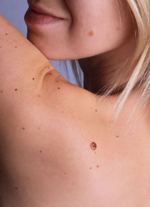 Mole Removal Treatment Bristol | Northwood Hospital