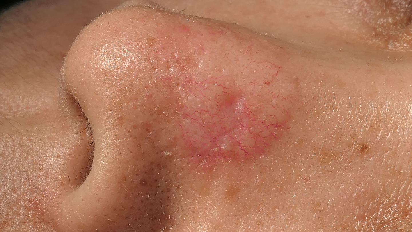 BCC Excision Treatment Bristol | Northwood Hospital