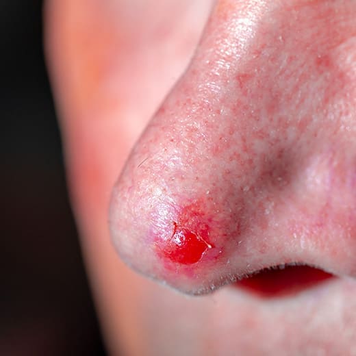 SCC Excision Treatment Bristol | Northwood Hospital